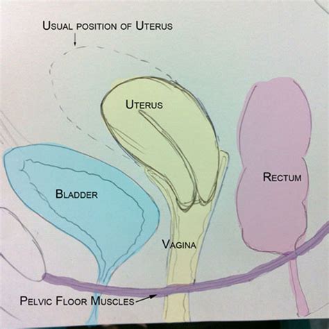 Cystocele Diagram Wiring Diagram Pictures