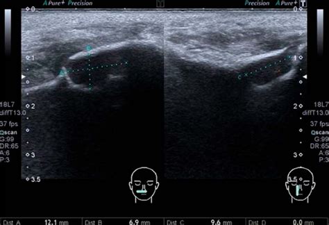 B Mode Ultrasonography Shows The Mesio Distal And Antero Posterior