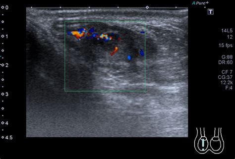Testicular Adrenal Rest Tumor Tart Image