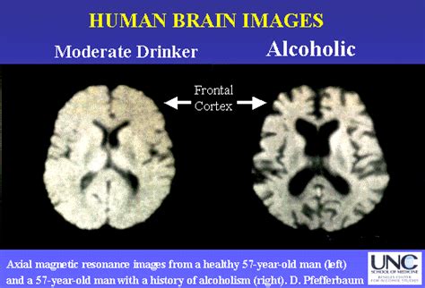 For Argument Does Alcohol Really Kill Brain Cells