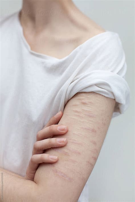 «sensual Woman With Pale Scars Arm Del Colaborador De Stocksy «vradiy