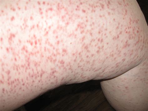 Urticaria Crónica Qué Es Síntomas Y Remedios Caseros Para Tratar La