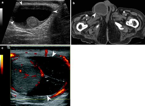 Imaging Of Acute Conditions Of Male Reproductive Organs Radiology Key