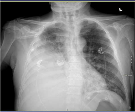 Chest X‐ray Bilateral Pneumonia And Large Right Pleural Effusion