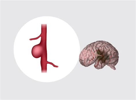 Brain Aneurysms Symptoms Diagnosis And Treatment