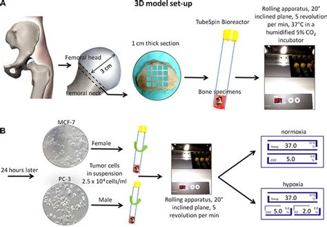 An In Vitro 3d Bone Metastasis Model By Using A Human Bone Tissue