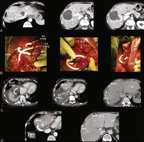 A Case Of Minor But Complex Hepatic Resection With Hepatic Vein