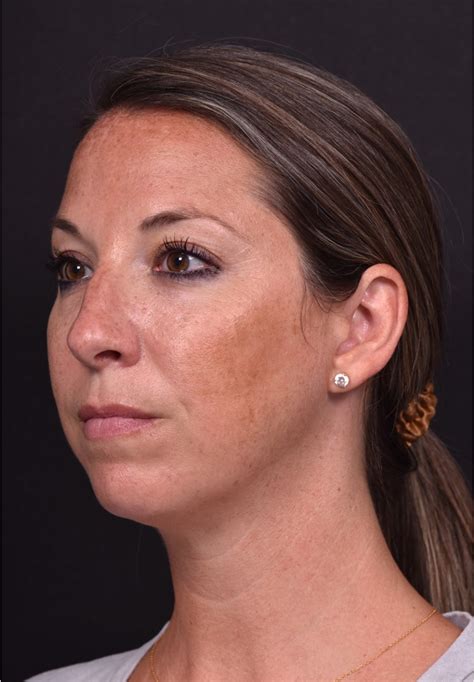 Dermal Fillers Case 18916 Aviva Plastic Surgery