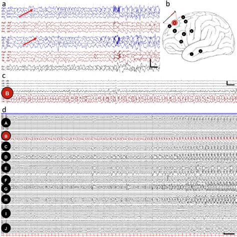 An Example Of Left Frontal F3 F7 Maximal Seizure Onset On Scalp Eeg