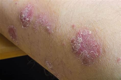 Psoriasis Aesthetic And Dermatology Center