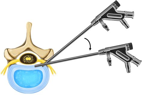Transforaminal Endoscopic Lumbar Discectomy Basic Concepts And