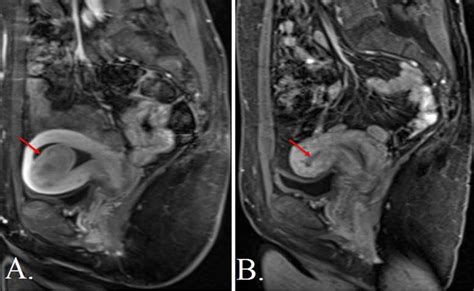 Uterine Artery Embolization Fibroids Ucla Health