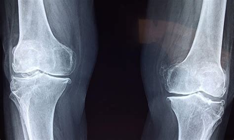 The Complete Guide To Osteoarthritis Kinetic Labs