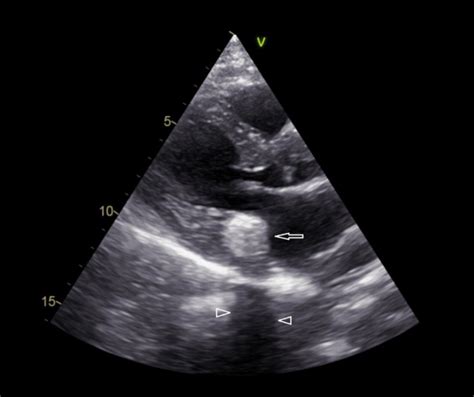 Caseous Calcification Of Mitral Annulus