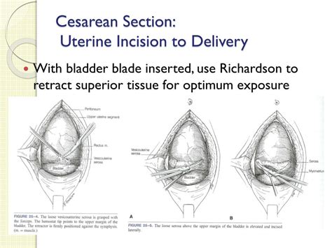 Ppt “youre Going To Suction What ” Cesarean Section Basics For Fp
