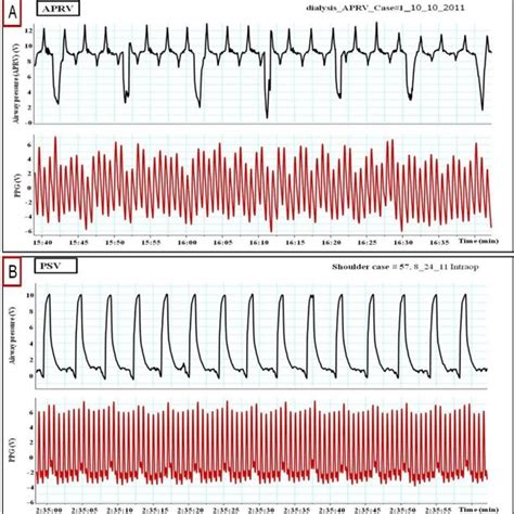 Impact Of Ventilation On Ppg Waveforms A Spontaneous Breathing B