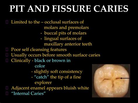 Ppt Dental Caries Powerpoint Presentation Free Download Id 9124776