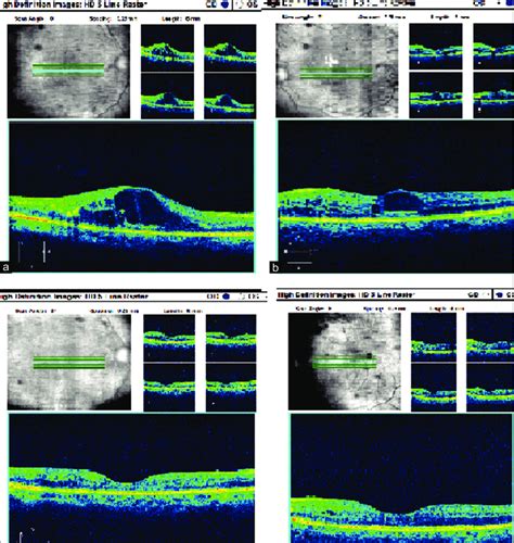 Optical Coherence Tomography Scans A And B Before Implantation