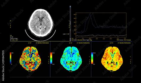 Ct Brain Perfusion Or Ct Scan Image Of The Brain 3d Rendering Image