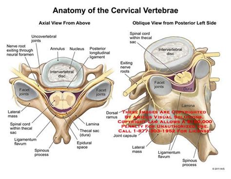 Severe Thecal Sac Compression Mapametawan