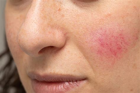 What Are Treatments For Rosacea