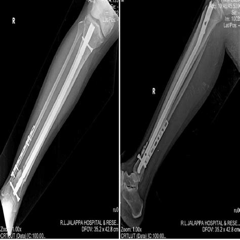 Nine Months Follow Up Ap And Lateral Radiographs Of A 36 Year Old