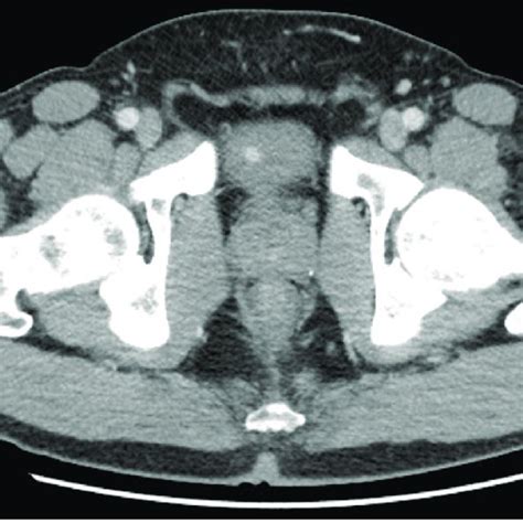 Computerized Tomography Imaging Of The Pelvis Showing An Enhancing