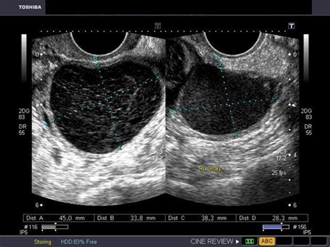 What Does Ovarian Cancer Look Like On An Ultrasound What Does