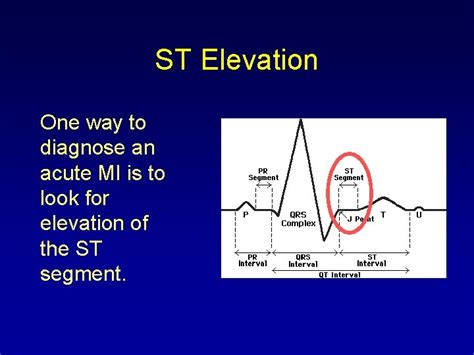 Ecg Rhythm Interpretation Module V Acute Myocardial Infarction