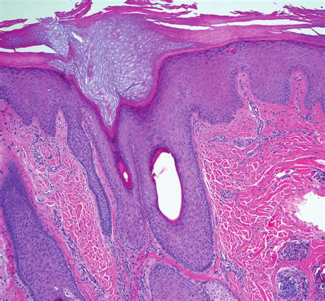 Lichen Simplex Chronicus Of The Posterior Scalp Shows Irregular