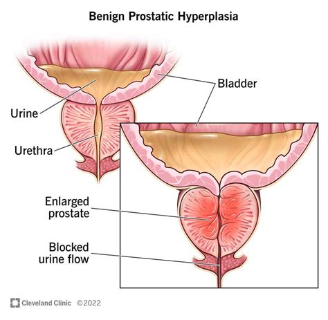 Benign Prostatic Hyperplasia Non Cancerous Prostate Problems