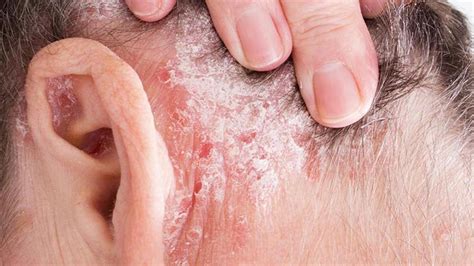 Psoriasis Síntomas Causas Y Cómo Tratar Esta Enfermedad De La Piel