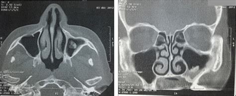 Mucosal Thickening Of Maxillary Sinus Doctorvisit