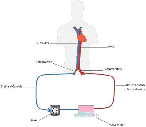 Cureus Extracorporeal Membrane Oxygenation Ecmo What We Need To Know