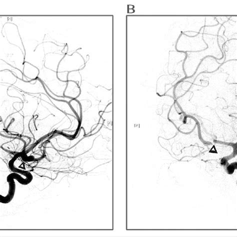 Anterior Communicating Artery Aneurysm Arrowhead Before A And After
