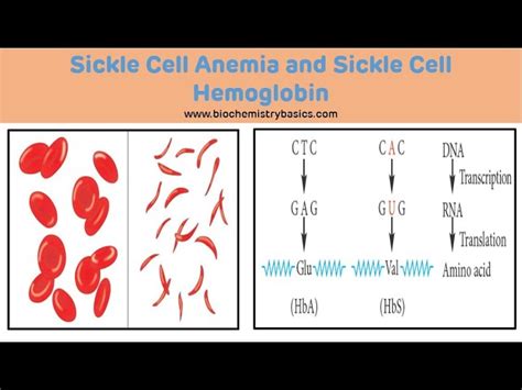 Sickle Cell Anemia