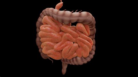 Inflammatory Bowel Disease Varies By Race Sex And Birthplace
