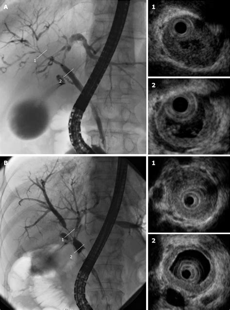 Figure 3 From Diagnosis Of Igg4 Related Sclerosing Cholangitis