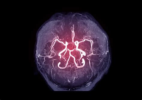 Mra Angiografía De Resonancia Magnética Mra De La Arteria Cerebral En