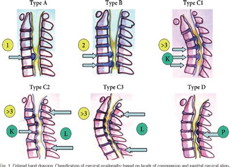 Figure 1 From Does Segmental Kyphosis Affect Surgical Outcome After A