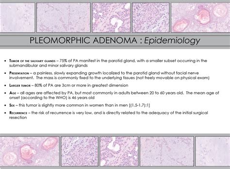 Pleomorphic Adenoma Iowa Head And Neck Protocols