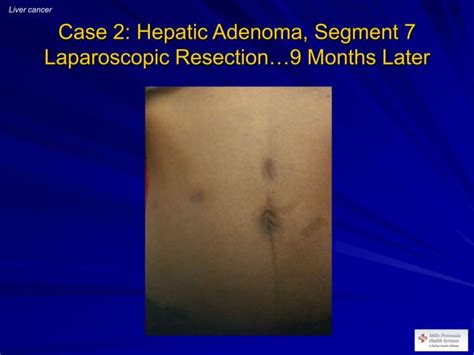 Minimally Invasive Liver Resection And Ablation For Malignancy