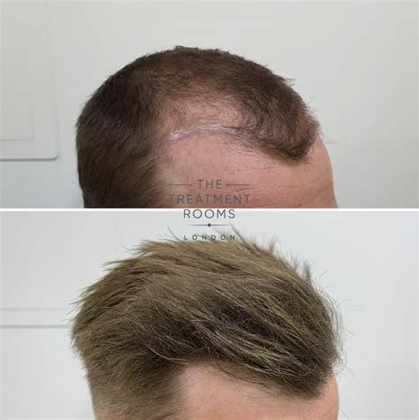 Fue Transplant Before And After Treatment Rooms London