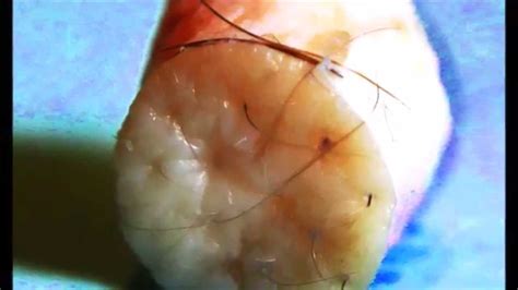 Sebaceous Cyst Removal Youtube
