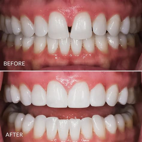 Smile Gallery Before And After Pictures Riverside Dental