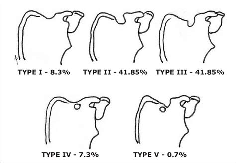 Natsis Classification For The Anatomical Type Of Scapular Incisure