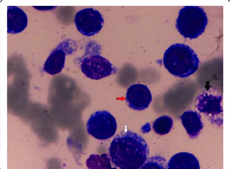 The Erythroid Precursors Show Dysplastic Morphology White Arrow With