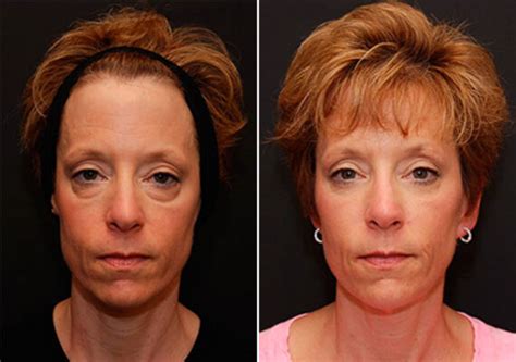 Blepharoplasty In Cincinnati Dr Alexander Donath