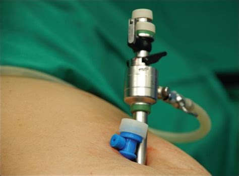 Single Incision Laparoscopic Cholecystectomy How I Do It Abstract
