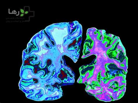 آلزایمر چیست؟ دلایل و علائم آلزایمر ،راه های تشخیص و درمان آلزایمر